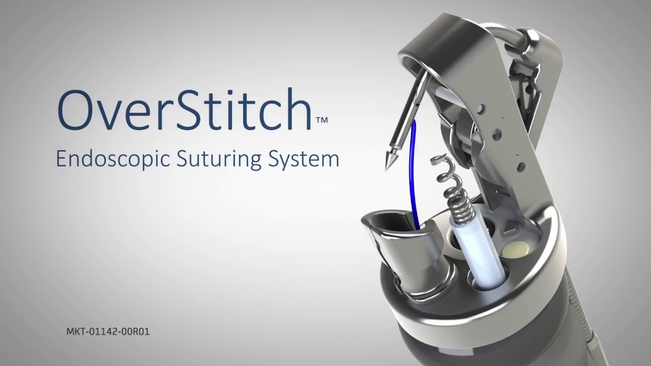 OVERSTITCH – SUTURA GÁSTRICA ENDOSCÓPICA – GASTROPLASTIA ENDOSCOPICA